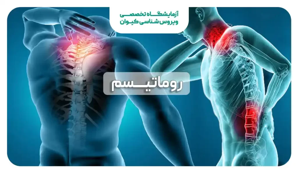 روماتیسم چیست و چگونه درمان می‌شود؟ | مجله سلامت کیوان